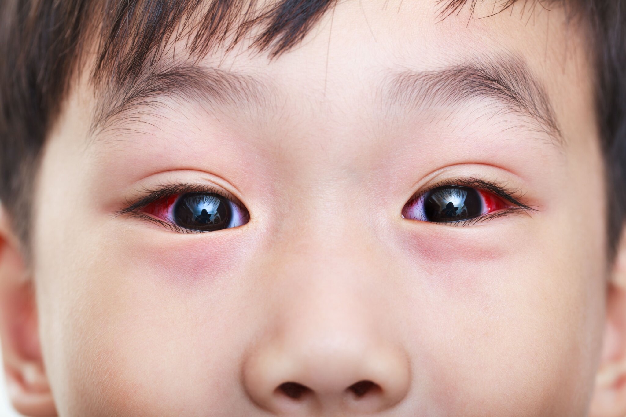 Derrames oculares en niños - Eres Mamá
