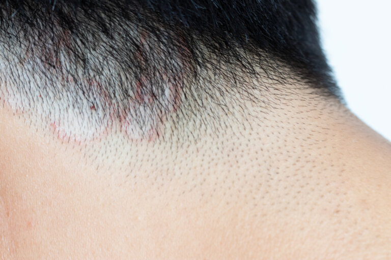 10 problemas de cabello en niños - Eres Mamá Enfermedades infantiles